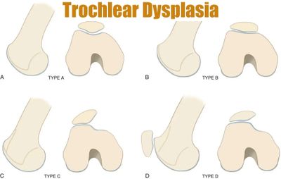 Daniel Elkin, MD - Trochleoplasty for Trochlear Dysplasia